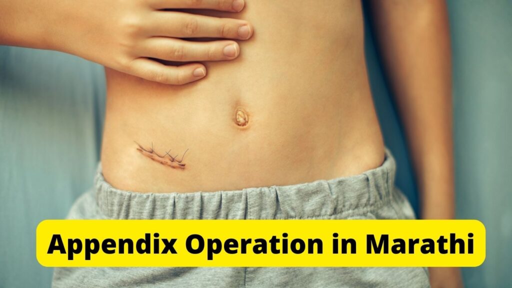 Appendix meaning in Marathi | Appendix operation in Marathi