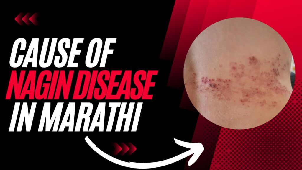Nagin disease in Marathi - नागीण आजारावर घरगुती उपाय - Mayboli.in